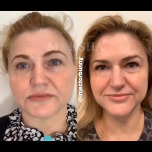 Before & After Gallery - Moksha Aesthetics Med Spa